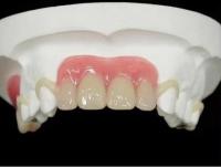 China Acetal Clasp Acrylic Denture Clasps 1.5mm Secure Hold for Prosthetics for sale