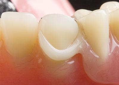 China Acetal Clasp Acrylic Denture Clasps 1.5mm Secure Hold for Prosthetics for sale