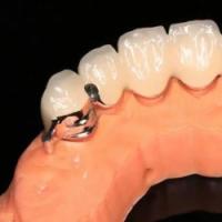 China Dental Precision Connector for Partial Dentures Improved Stability Aesthetic Design 2 Piece for sale