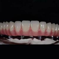 China Dental Implant Screw PFM Richmond Crown 15 Year Durability Osseointegration for sale