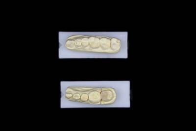 China Minimally Invasive Composite Inlay for Posterior Teeth Restoration 2mm Thickness for sale