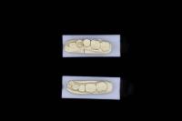 China Minimally Invasive Composite Inlay for Posterior Teeth Restoration 2mm Thickness for sale