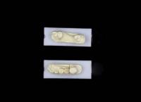China Composite Inlay for Posterior Teeth Restoration Minimally Invasive 2mm Thickness for sale