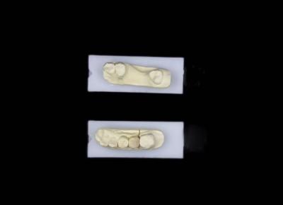 China Composite Inlay for Posterior Teeth Restoration Minimally Invasive 2mm Thickness for sale