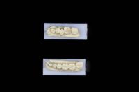 China Composite Inlay for Posterior Teeth Restoration Minimally Invasive 2mm Thickness for sale