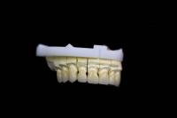 China Abutment Supported Porcelain Fused to Metal Crown PFM Dental Restoration 3 Unit Bridge for sale