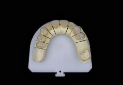 China Abutment Supported Porcelain Fused to Metal Crown PFM Dental Restoration 3 Unit Bridge for sale