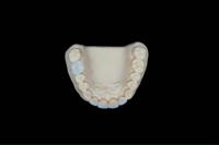 China Lithium Disilicate E Max Crown All Ceramic Dental Restoration 360 MPa Flexural Strength for sale