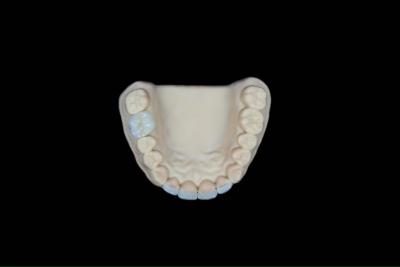 China Lithium Disilicate E Max Crown All Ceramic Dental Restoration 360 MPa Flexural Strength for sale