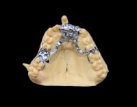 China Nickel Chromium Dental Metal Framework CAD CAM Fit Digital Processing 100mm for sale
