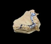China Nickel Chromium Dental Metal Framework CAD CAM Fit Digital Processing 100mm for sale