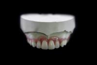 China China Dental Outsourcing Valplast Partial Denture Biocompatible Nylon Resin Flexible 1950s for sale