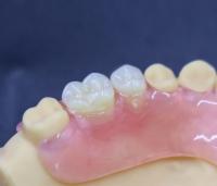 China Removable Valplast Partial Denture High Flexibility Biocompatible Nylon Resin Metal-Free Dental Lab for sale