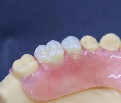 China Removable Valplast Partial Denture High Flexibility Biocompatible Nylon Resin Metal-Free Dental Lab for sale