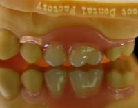 China Valplast Flexible Partial Denture Biocompatible Nylon Resin Metal-Free Fracture Resistance 1950s Trusted for sale