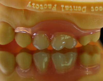 China Valplast Flexible Partial Denture Biocompatible Nylon Resin Metal-Free Fracture Resistance 1950s Trusted for sale