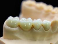 China Metal Free Dental Lab CAD CAM Full Zirconia Crown 1200 MPa Flexural Strength for sale