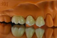 China CAD CAM Dental Zirconia Full Contour Crown 1200 MPa High Strength Metal-Free for sale