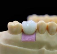China Dental Implant System Pure Titanium Tapered Body 4mm Diameter for Prosthodontics for sale