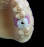China Commercially Pure Titanium Dental Implant System Tapered Body Internal Connection 4.0mm for sale