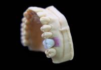 China Prosthodontics Dental Implant System Screw Retained Cement Retained CP Titanium Internal Connection for sale