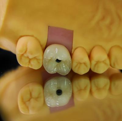 China Digital Dental Implant System 5.0mm-7.0mm Wide Diameter Tapered Body Internal Connection for sale