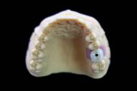 China Digital Dental Implant System 5.0mm-7.0mm Wide Diameter Tapered Body Internal Connection for sale