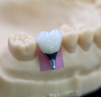 China CPTi Ti-6Al-4V Dental Implant System 4.1mm x 10mm Internal Connection for Prosthodontics for sale