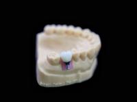 China Titanium Dental Implant System Screw Retained Internal Connection for Prosthodontics for sale
