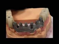 China Titanium Dental Implant System 3.75mm-4.5mm Diameter Screw Retained Internal Connection for sale