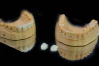 China China Dental Lab Porcelain Veneers 0.3mm Ultra Thin Stain Resistance Minimally Invasive for sale