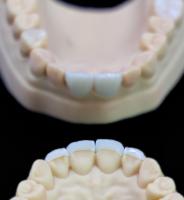 China Dental Ceramic Veneer 0.3mm Ultra Thin Stain Resistance Composite Veneer for Anterior Teeth for sale