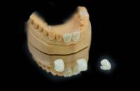 China Custom Anatomical Dental Veneers Porcelain 0.3mm China Dental Outsourcing for sale