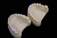 China Custom Dental Veneers Porcelain 0.3mm Ultra Thin Minimally Invasive Ceramic Veneer for sale