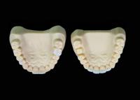 China Custom Dental Veneers 0.3mm Stain Resistant Porcelain Veneers for Minimally Invasive Smile Makeover for sale