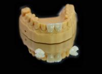 China Custom Porcelain Dental Veneers 0.3mm Stain Resistance Minimally Invasive Prosthesis for sale