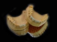 China Custom Porcelain Dental Veneers 0.3mm Stain Resistance Minimally Invasive Prosthesis for sale