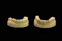 China Translucent Dental Veneers Stain Resistant Porcelain Veneers 0.3mm Custom Dental Lab for sale