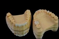 China Custom Porcelain Veneers 0.3mm Minimally Invasive Stain Resistant Dental Veneer for sale