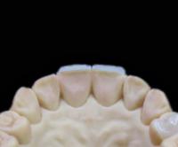 China Custom Translucent Dental Ceramic Veneers 0.3mm Ultra Thin Porcelain Veneer for sale