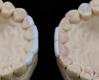 China Custom Translucent Dental Ceramic Veneers 0.3mm Ultra Thin Porcelain Veneer for sale