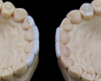 China Custom Translucent Dental Ceramic Veneers 0.3mm Ultra Thin Porcelain Veneer for sale
