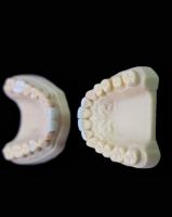 China Custom Porcelain Veneers Stain Resistance 0.3mm Dental Lab Outsourcing for sale