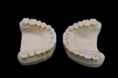 China Custom Anatomical Porcelain Veneers 0.3mm Ultra Thin Dental Veneers Stain Resistance for sale