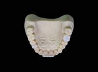 China Durable Flexible Dental Veneers 0.3mm Stain Resistant Porcelain Veneers for Minimally Invasive Smile Makeover for sale