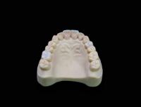 China Minimally Invasive Porcelain Veneer Teeth 0.3mm Custom Dental Crowns for sale