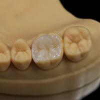 China Lithium Disilicate Emax Inlay Digital Dental Design Service 530 MPa for sale