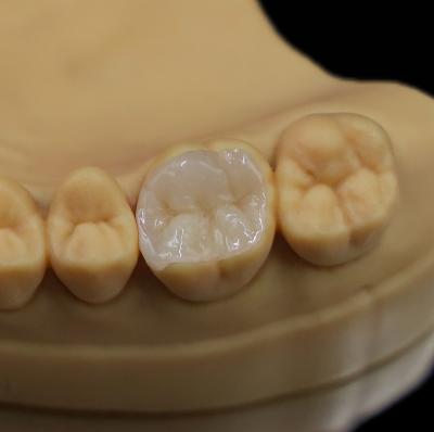 China Lithium Disilicate Emax Inlay Digital Dental Design Service 530 MPa for sale