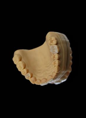 China CE Heat Pressed Lithium Disilicate Emax Inlay 470 MPa Dental Restoration for sale