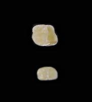 China CE Heat Pressed Lithium Disilicate Emax Inlay 470 MPa Dental Restoration for sale